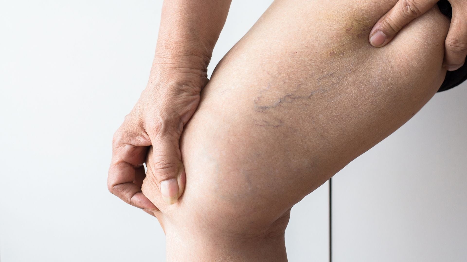 Varis Nedir? – Cannaderm